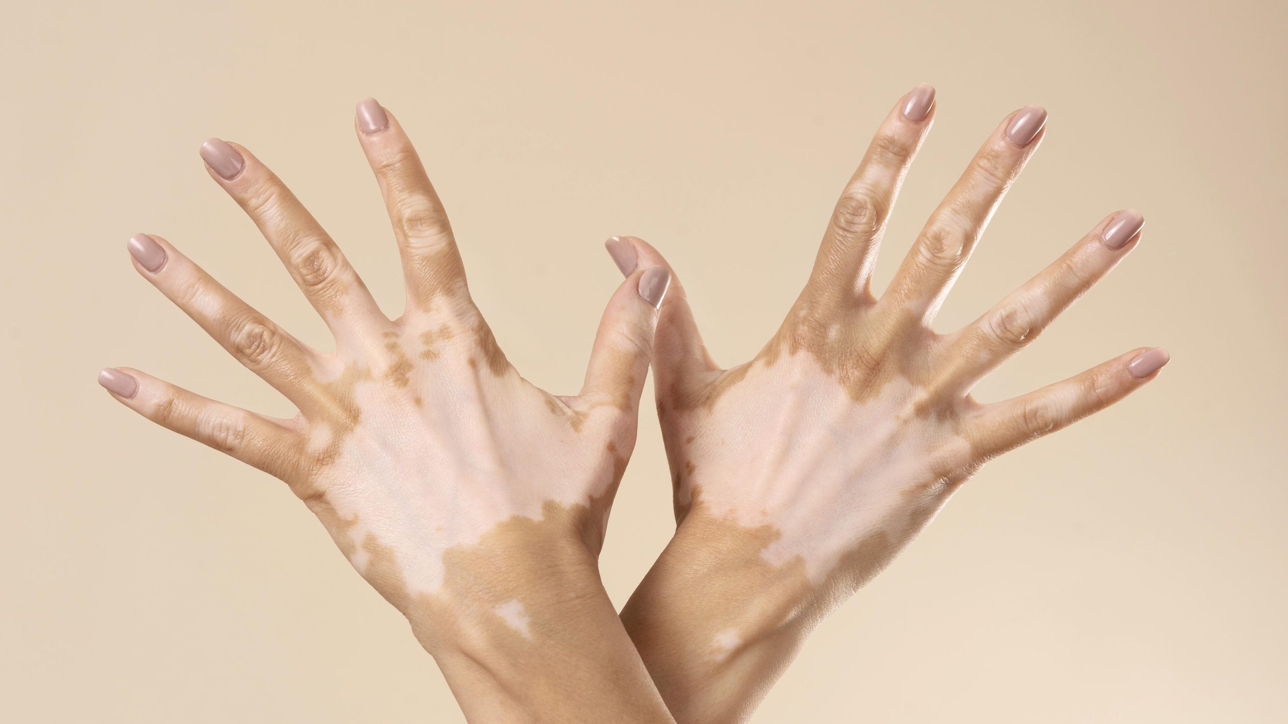 Vitiligo Wallpapers - Wallpaper Cave