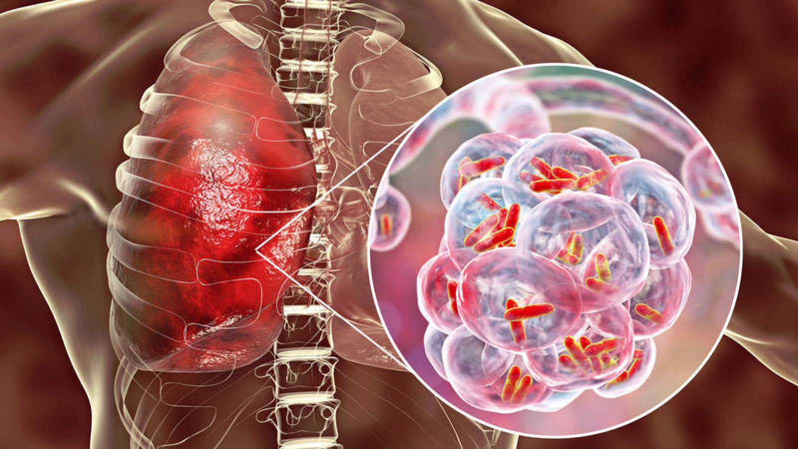 Tuberculosis Wallpapers - Wallpaper Cave