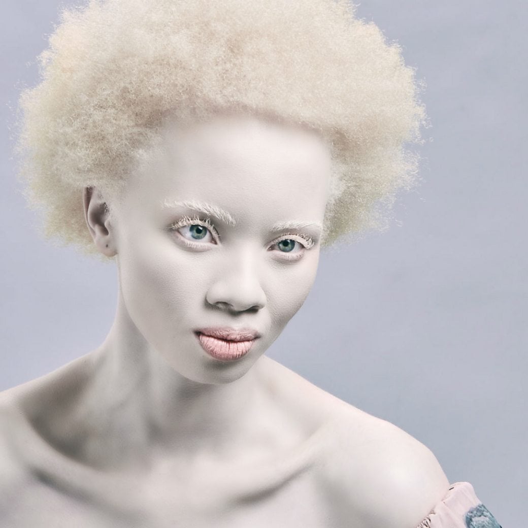 Albinism Wallpapers - Wallpaper Cave