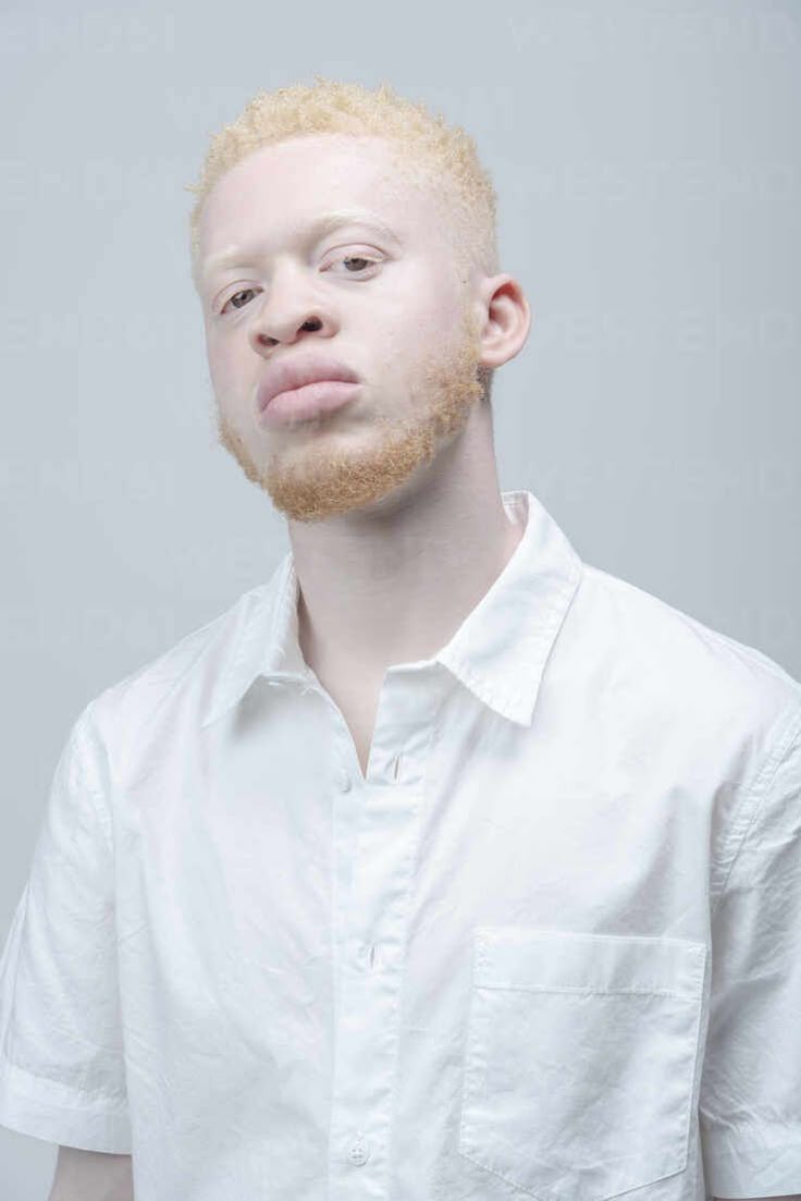 Albinism Wallpapers - Wallpaper Cave