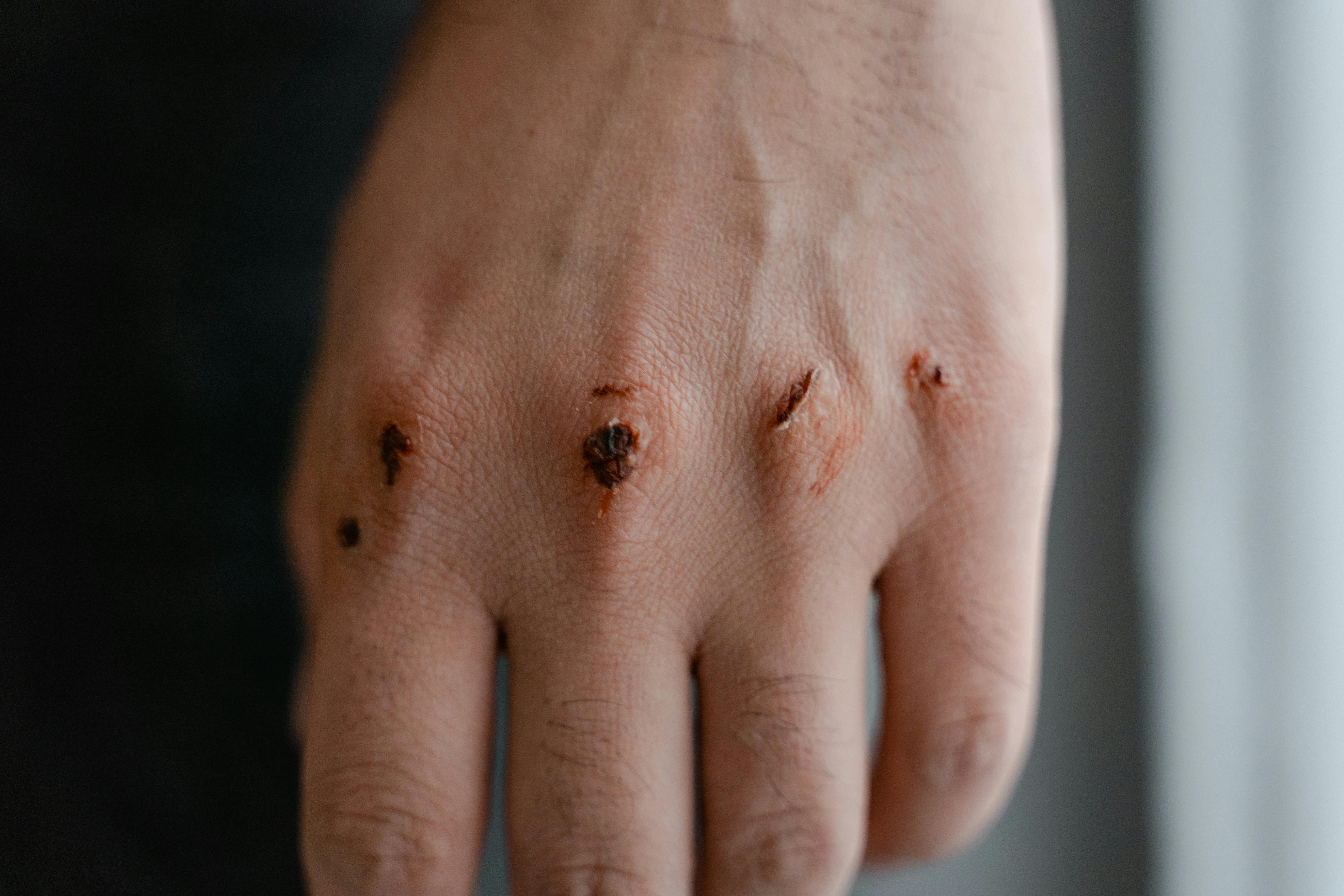 Bruise Wallpapers - Wallpaper Cave