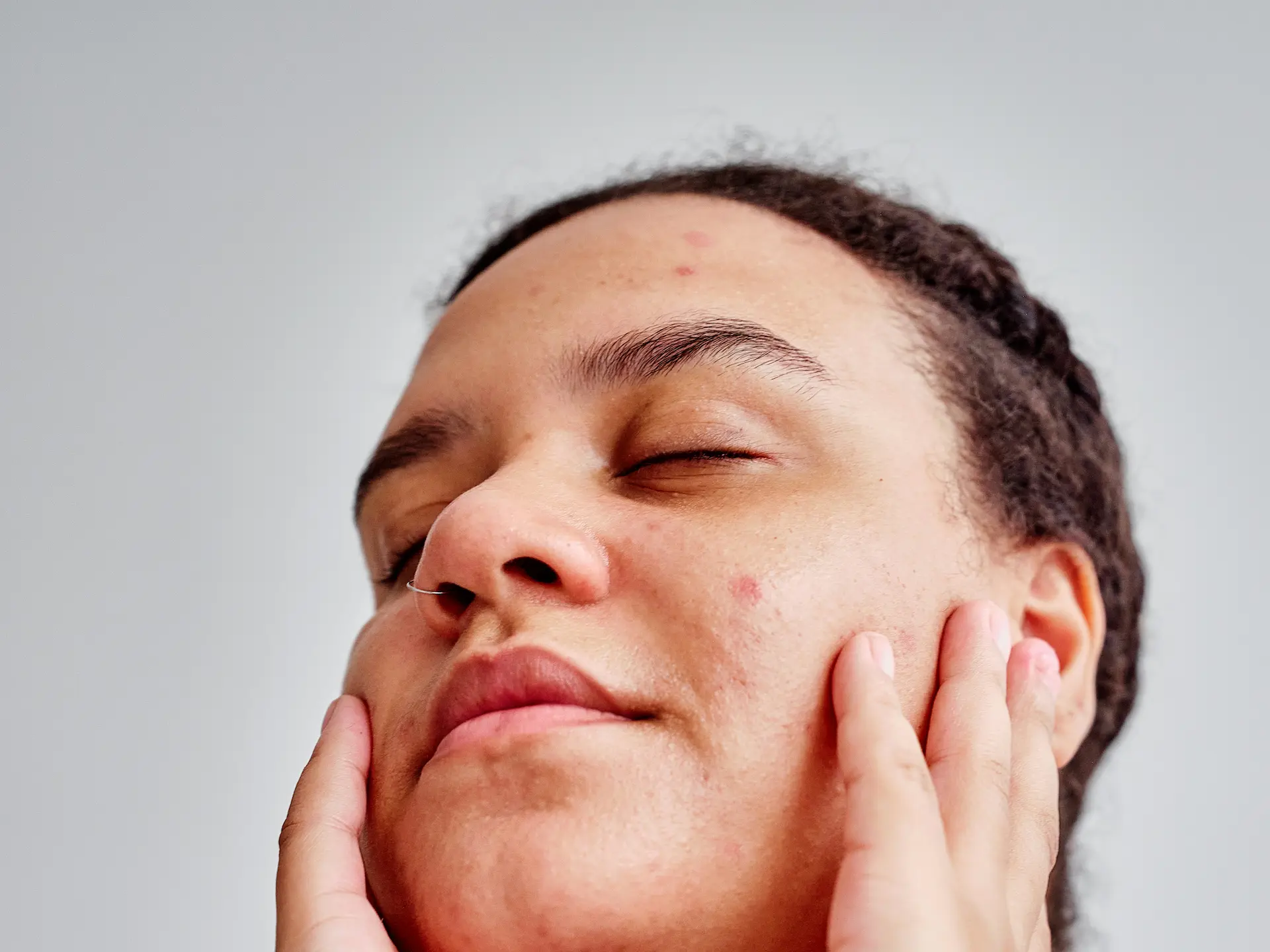Hyperpigmentation Wallpapers - Wallpaper Cave