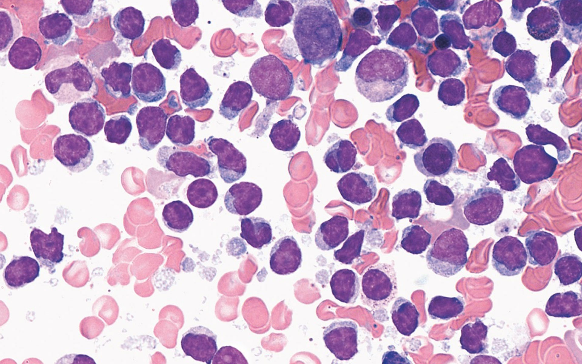 Leukemia Wallpapers - Wallpaper Cave